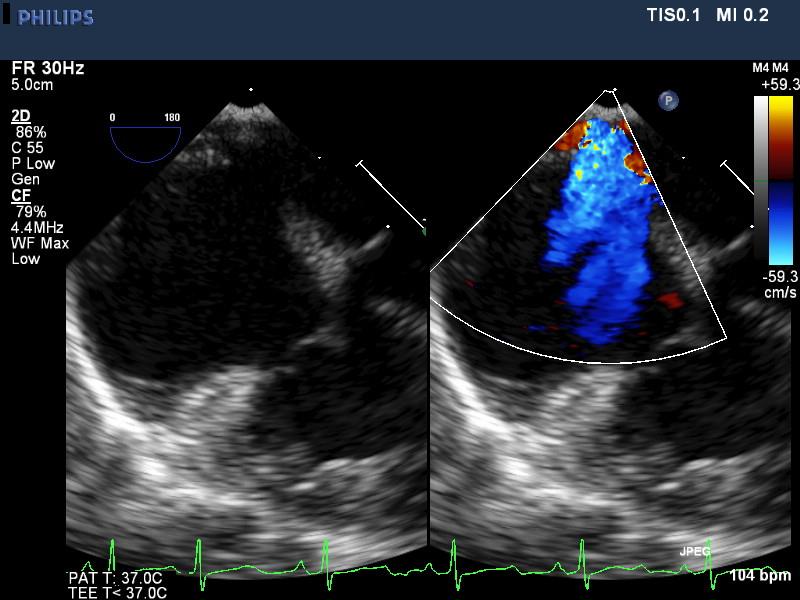 Atrial Septal Defects - Congenital Cardiac Anesthesia Society