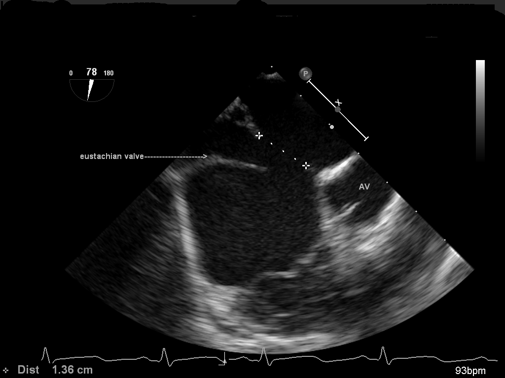 Atrial Septal Defects - Congenital Cardiac Anesthesia Society