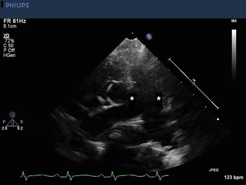 Atrial Septal Defects - Congenital Cardiac Anesthesia Society