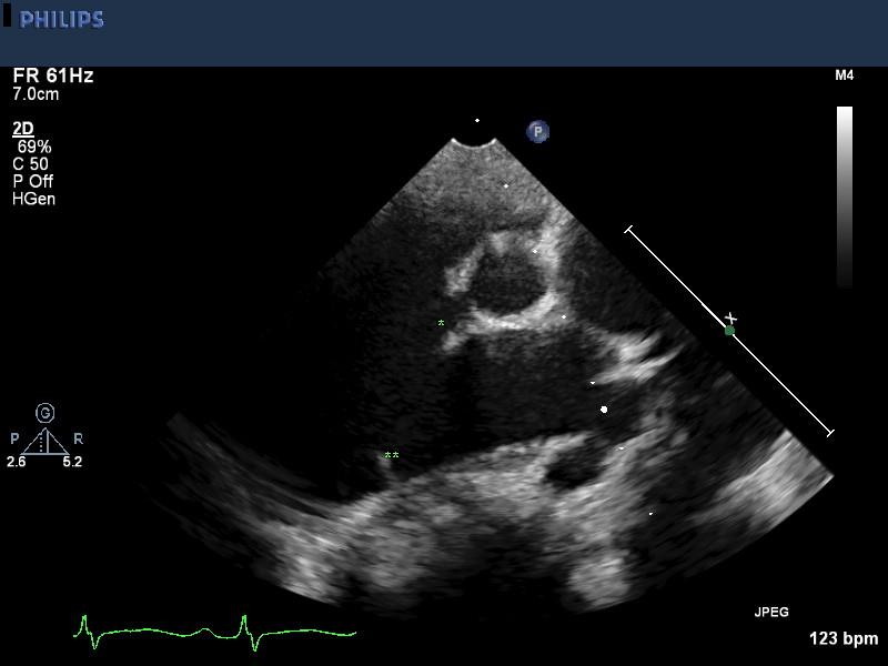 Atrial Septal Defects - Congenital Cardiac Anesthesia Society