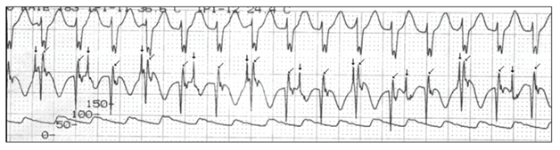 Week 103 - Arrhythmia - Congenital Cardiac Anesthesia Society